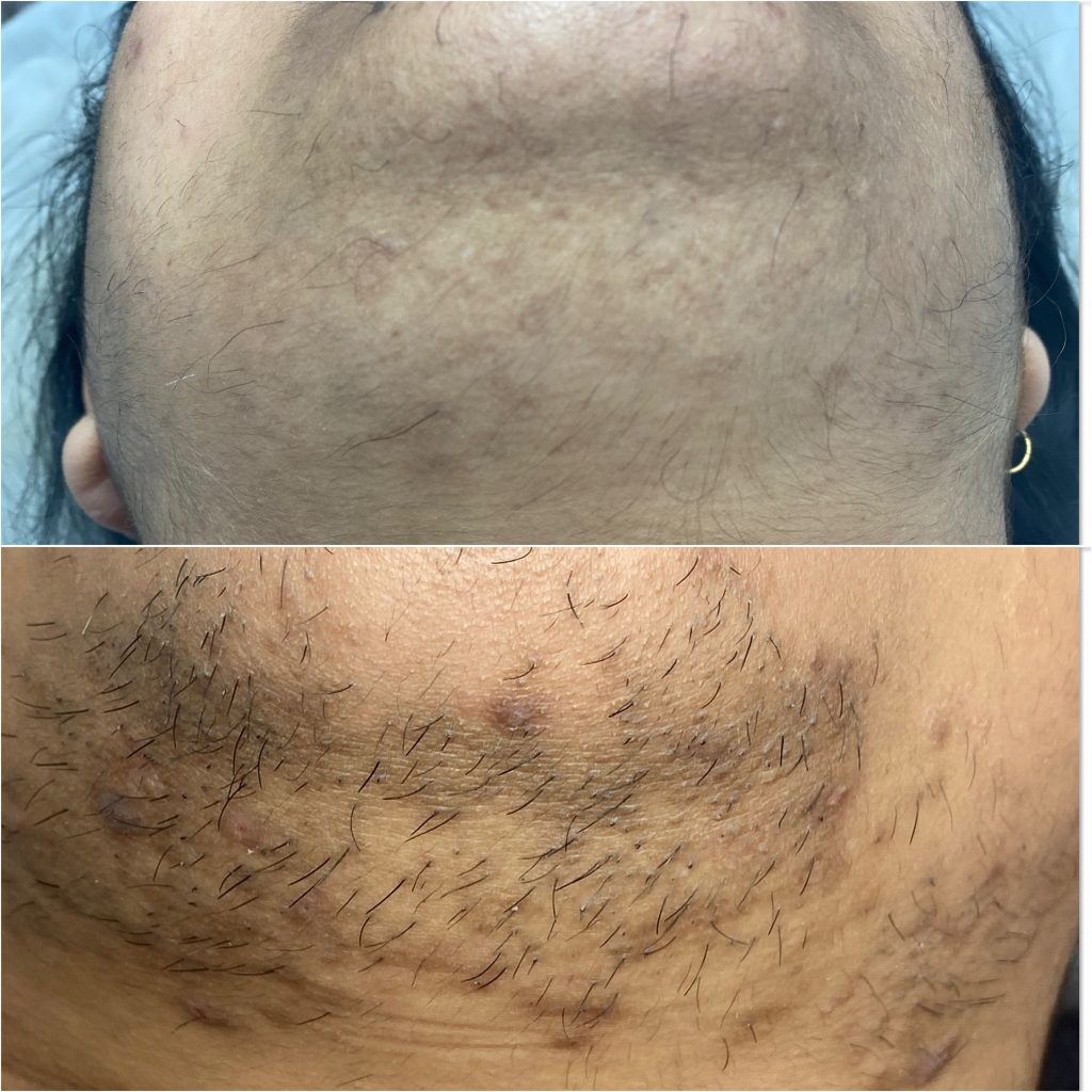 Permanent Hair Removal | Glamaholic Salon