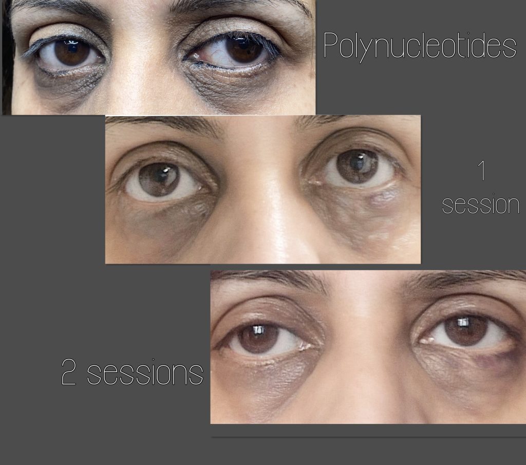 The Ultimate Polynucleotide Treatment for Skin Rejuvenation 5 Proven ...